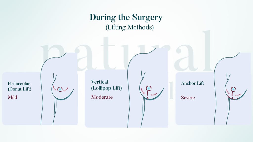 Breast Lift Surgery (mastopexy) in Turkey | Natural Clinic